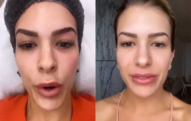 Lore Improta faz tratamento estético. Veja o ‘antes e depois’! - OFuxico
