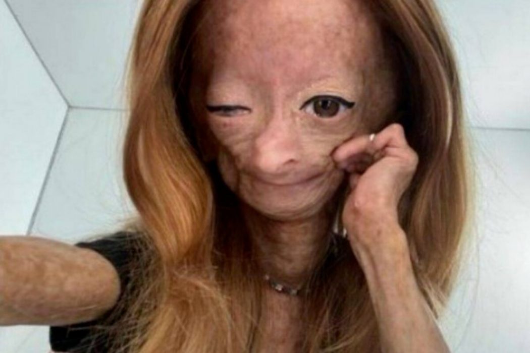 Morre Adalia Rose youtuber de 15 anos que tinha doença rara