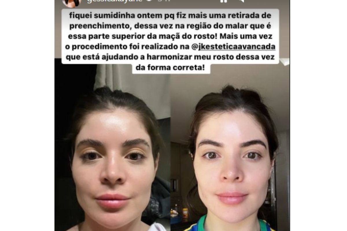 Gkay se desfaz de procedimento no rosto: 'Harmonizar da forma correta'