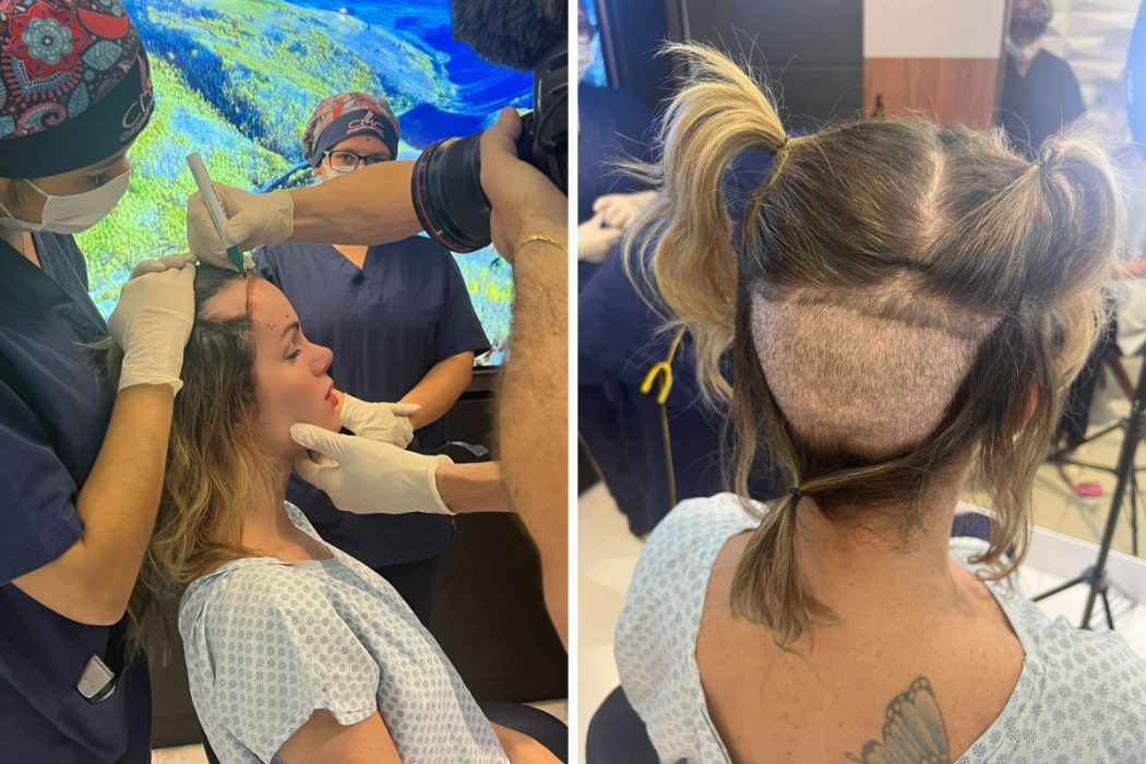 Thalita Zampirolli realiza transplante capilar avaliado em R$ 50 mil