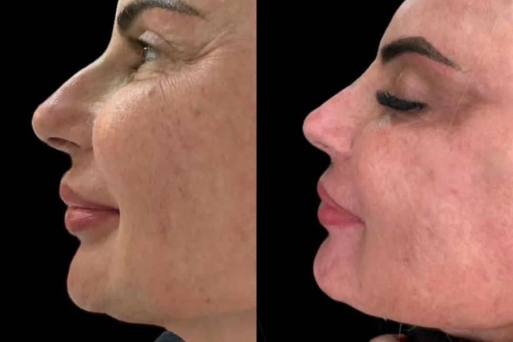 Stênio Garcia sobre harmonização: 'Me sinto com menos de 15 anos'