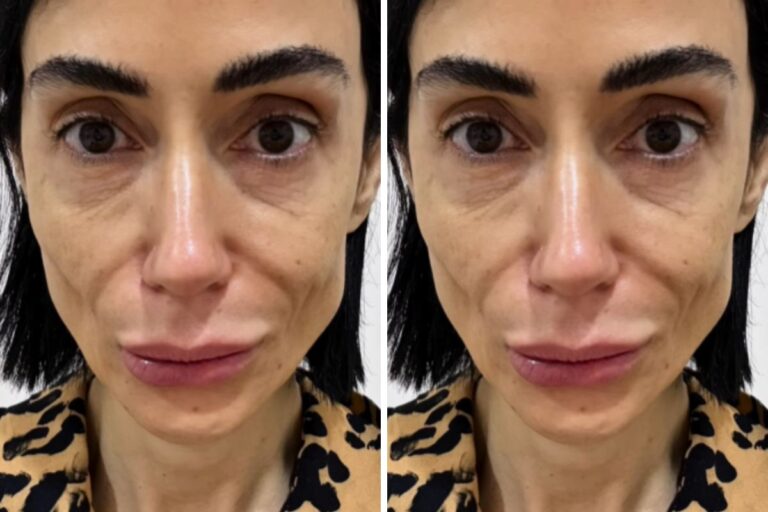 Michelle Barros choca ao retirar preenchimento do rosto - OFuxico